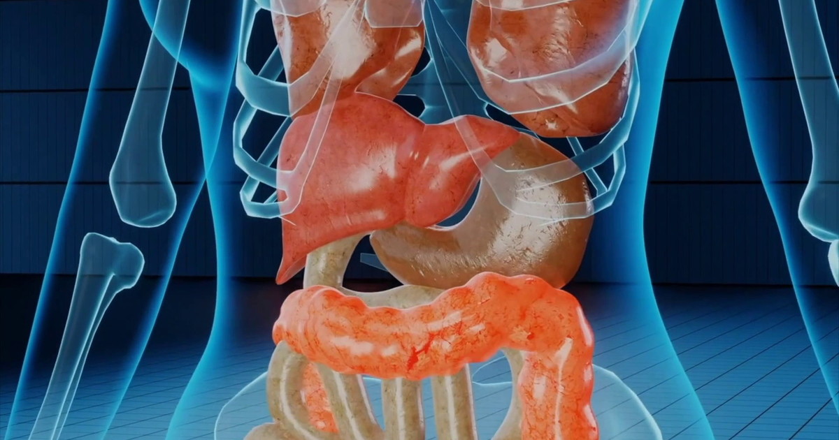Calcoli biliari, disturbo diffuso. Ecco cosa fare se ne soffri – Il Tempo